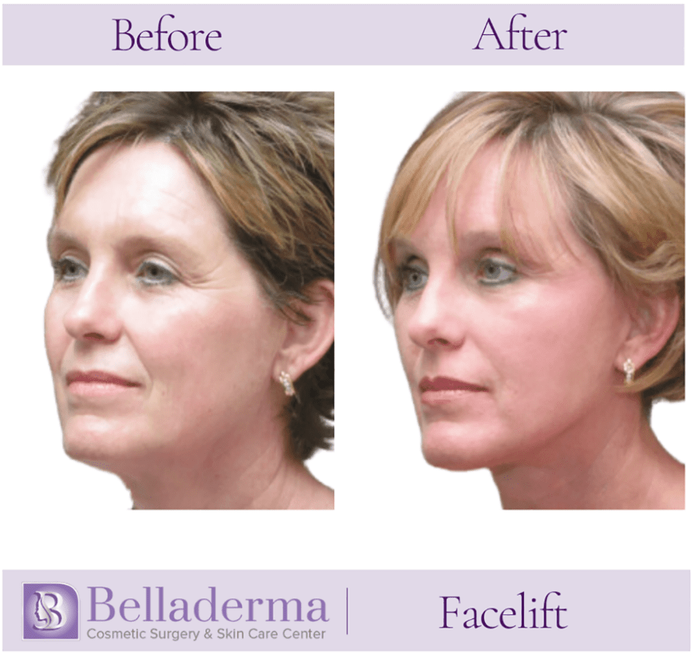 Belladerma Mini Facelift San Diego, CA | San Diego Belladerma Mini Facelift