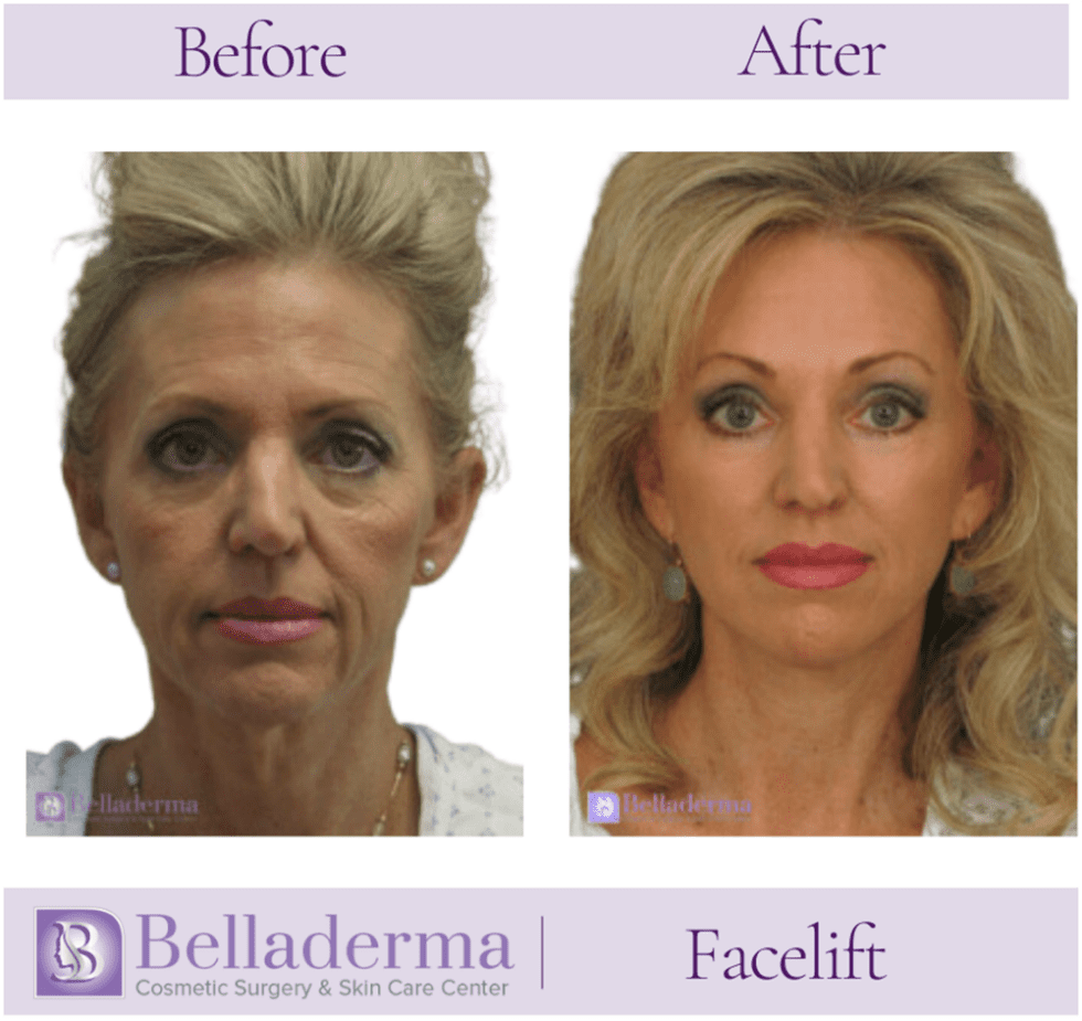 Belladerma Mini Facelift San Diego, CA | San Diego Belladerma Mini Facelift