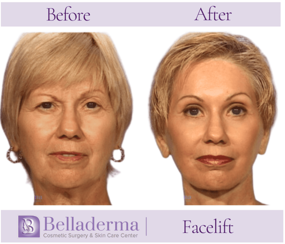 Belladerma Mini Facelift San Diego, CA | San Diego Belladerma Mini Facelift